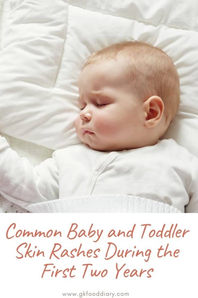 Common Baby Rashes: An In-Depth Look and Tips for Treatment